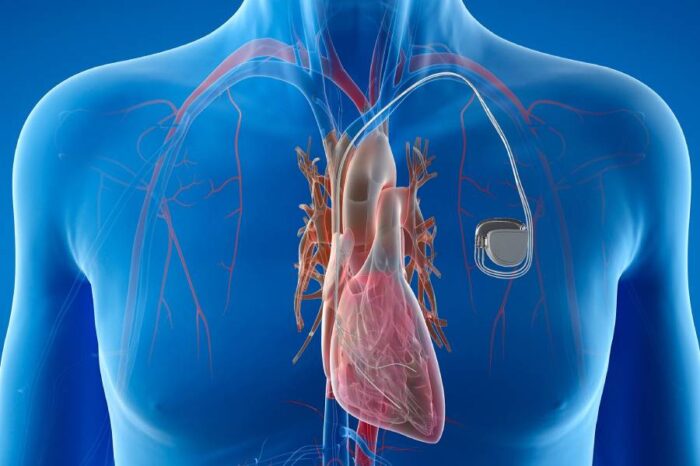 Permanent Pacemaker – Dr. Dhananjay Ware